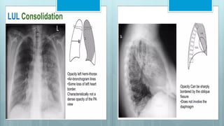 Radiological imaging of collapse vs consolidation vs fibrosis.pptx