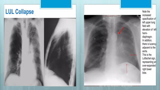 Radiological imaging of collapse vs consolidation vs fibrosis.pptx