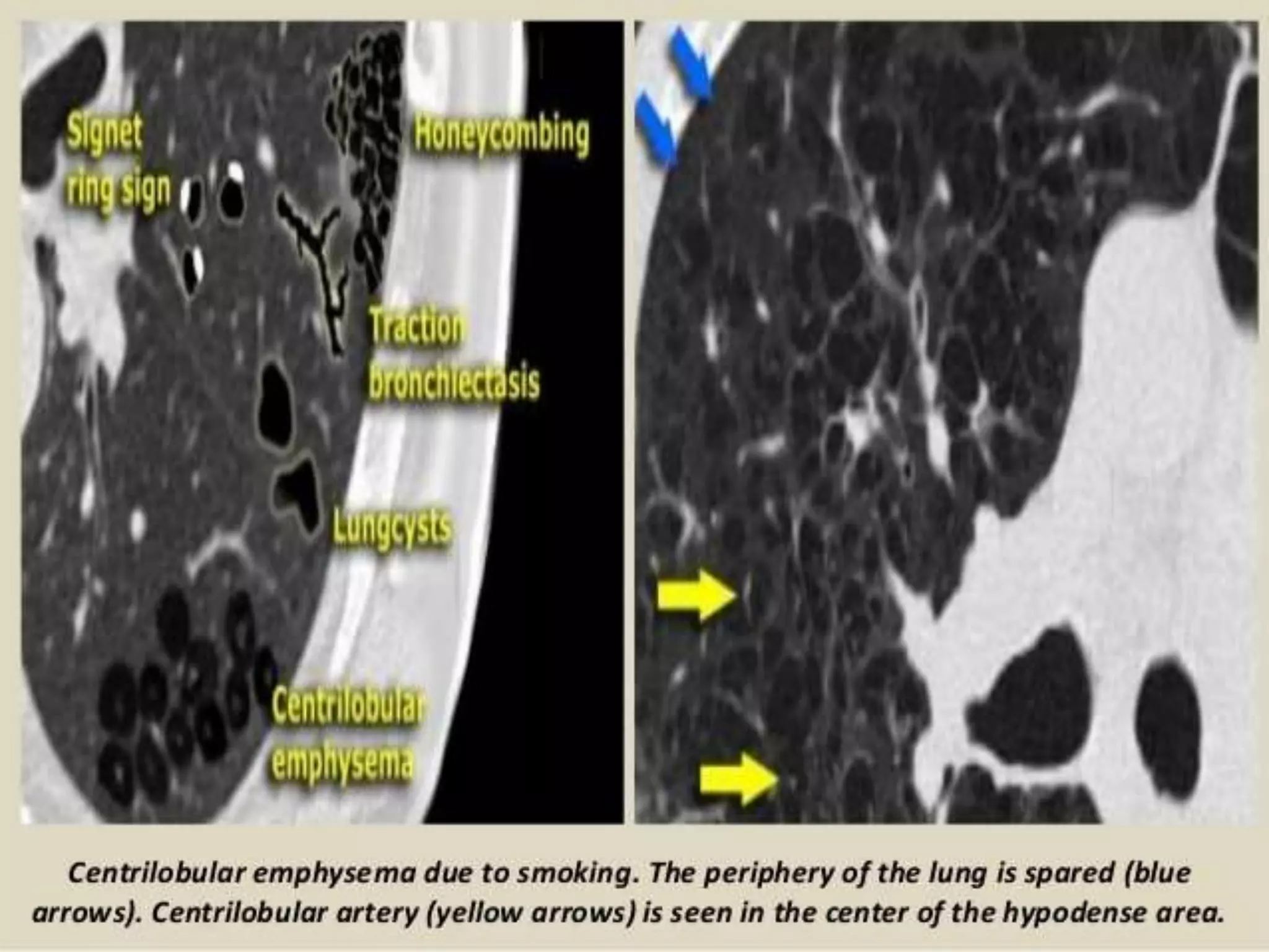 Radiological imaging of copd | PPTX