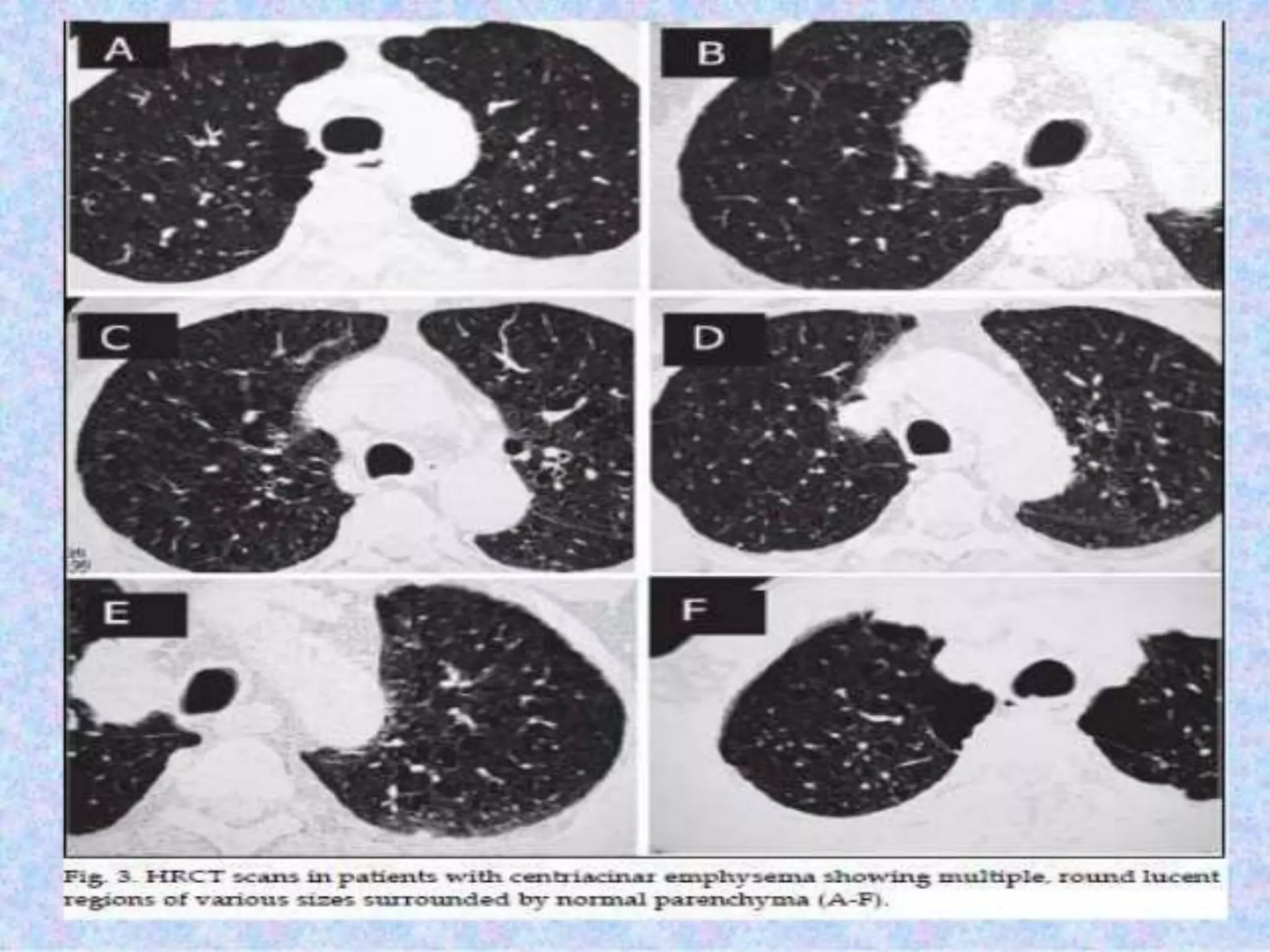 Radiological imaging of copd | PPTX