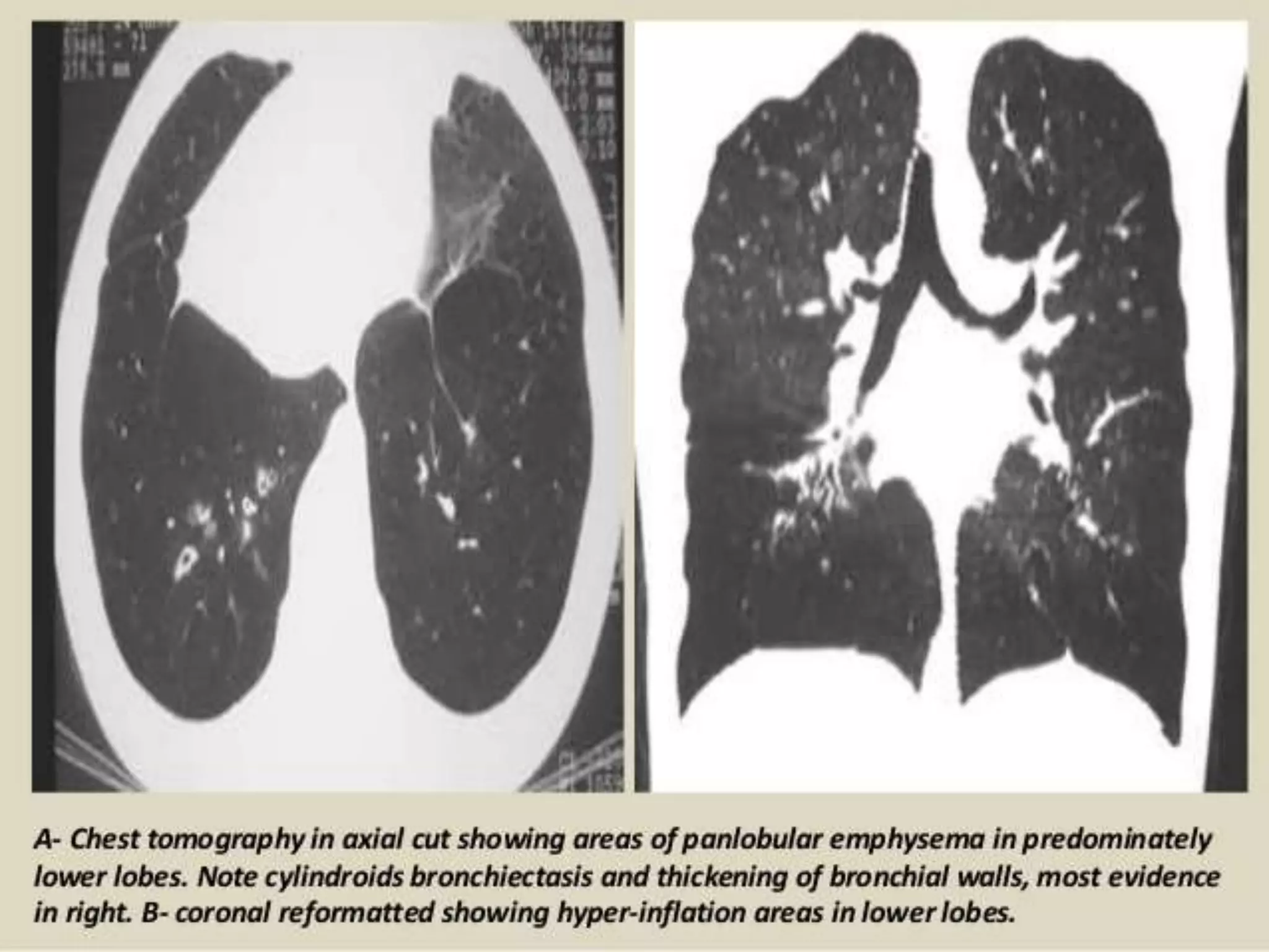 Radiological imaging of copd | PPTX
