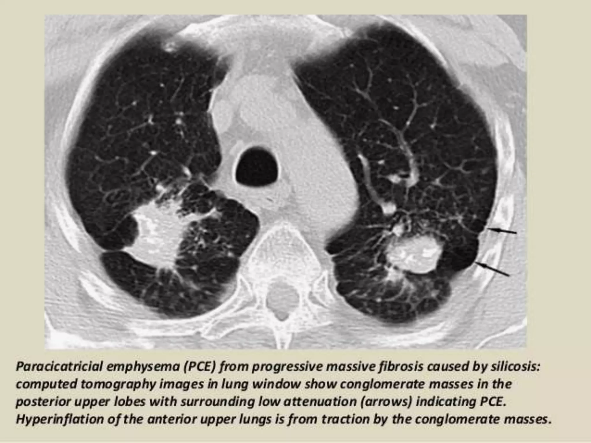 Radiological imaging of copd | PPTX