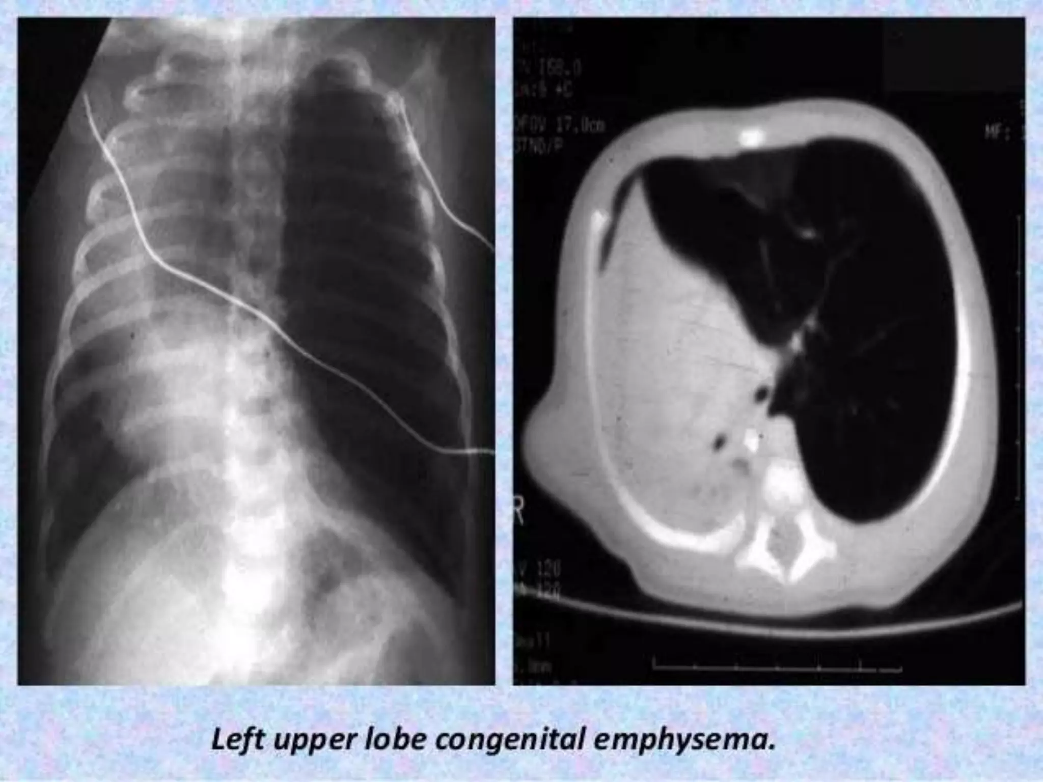 Radiological imaging of copd | PPTX