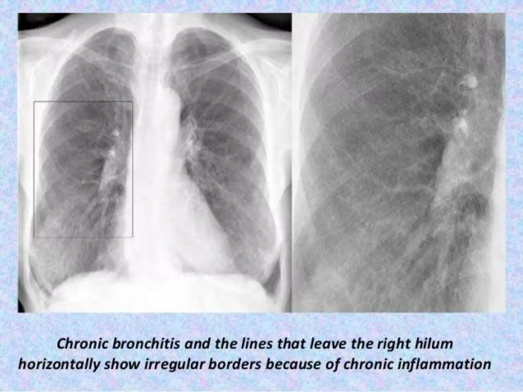 Radiological imaging of copd | PPTX