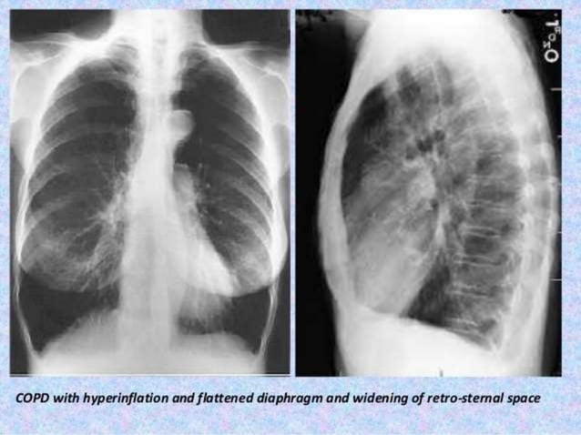 Radiological imaging of copd | PPTX | Lung and Respiratory Health ...