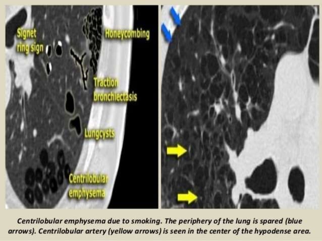 Radiological imaging of copd | PPTX | Lung and Respiratory Health ...