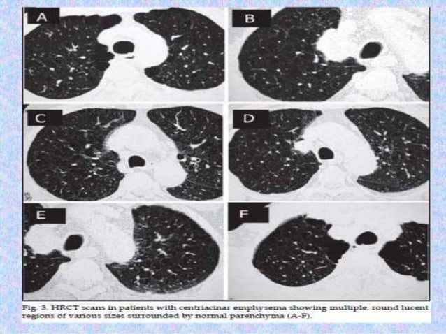 Radiological imaging of copd | PPTX | Lung and Respiratory Health ...