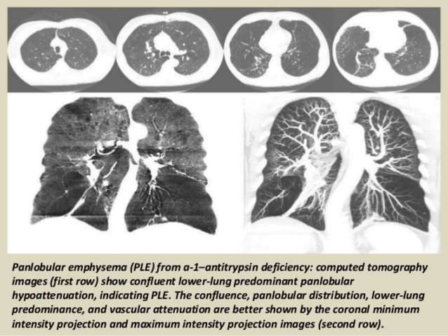 Radiological imaging of copd | PPTX | Lung and Respiratory Health ...