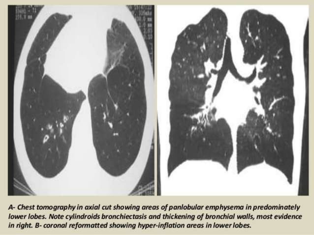 Radiological imaging of copd | PPTX | Lung and Respiratory Health ...