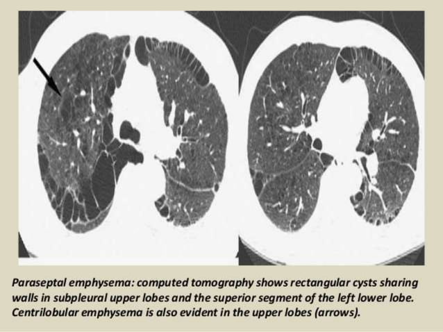 Radiological imaging of copd | PPTX | Lung and Respiratory Health ...