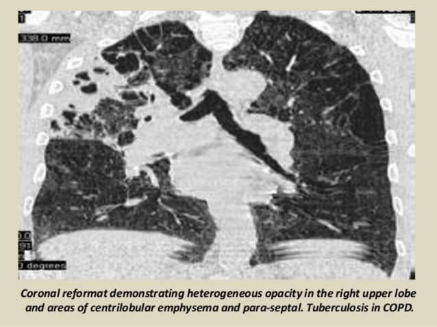 Radiological imaging of copd | PPT
