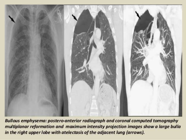 Radiological imaging of copd | PPTX | Lung and Respiratory Health ...