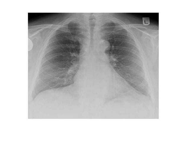Radiological imaging of copd | PPTX | Lung and Respiratory Health ...