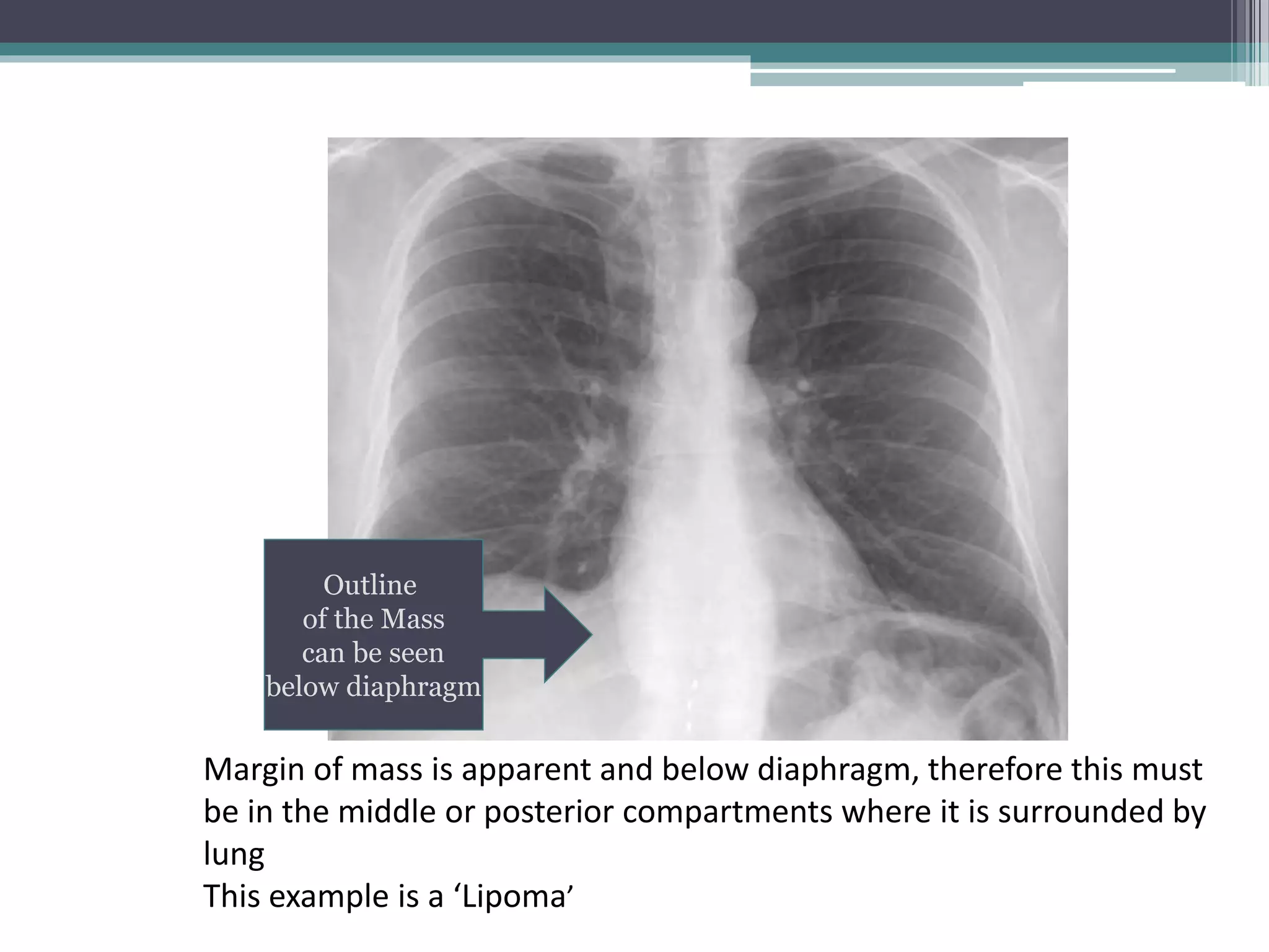 Radiological imaging of mediastinal masses | PPTX