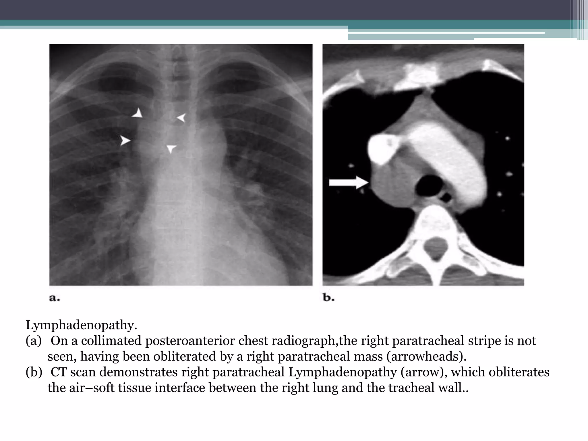 Radiological imaging of mediastinal masses | PPTX