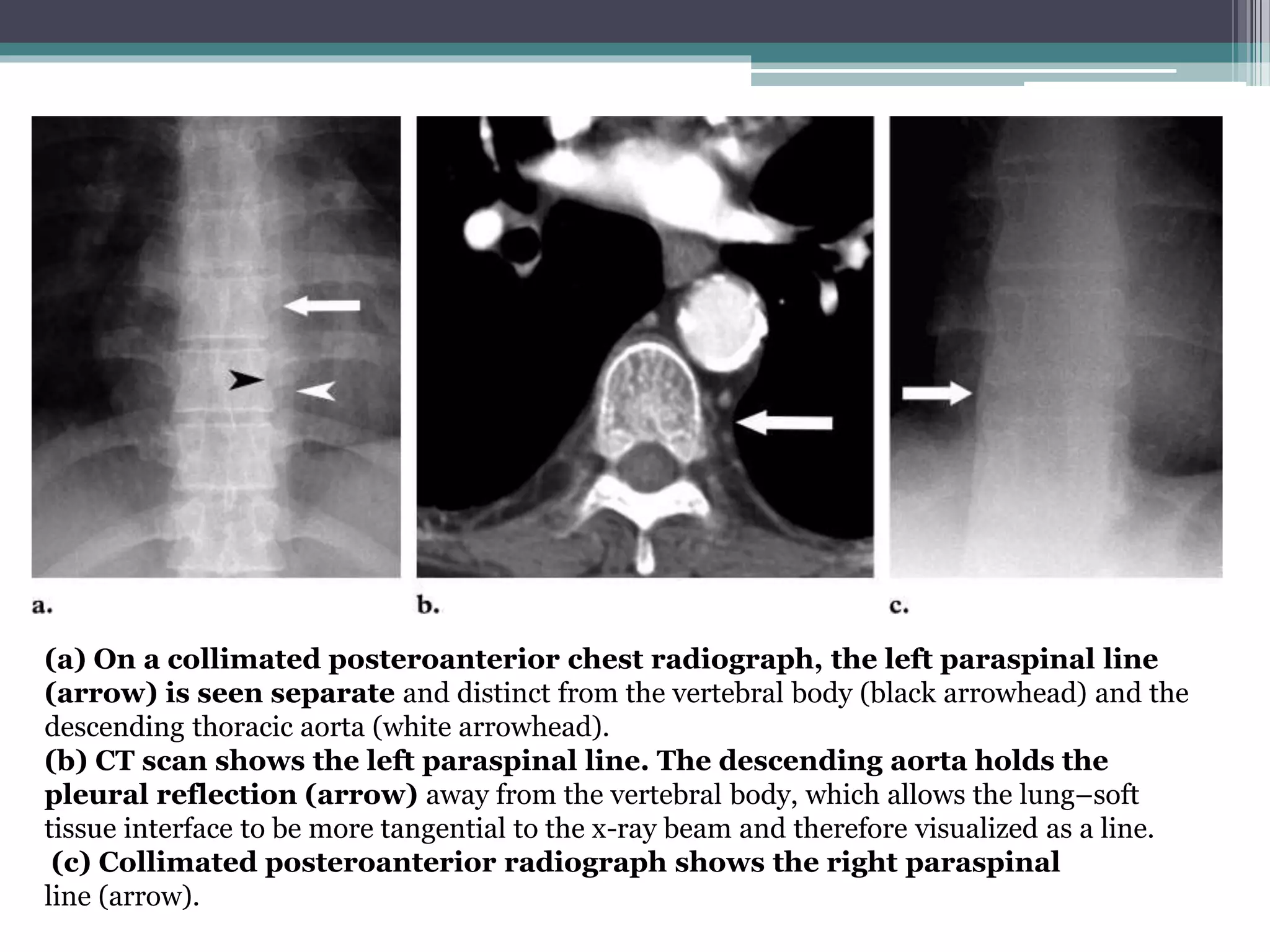 Radiological imaging of mediastinal masses | PPTX