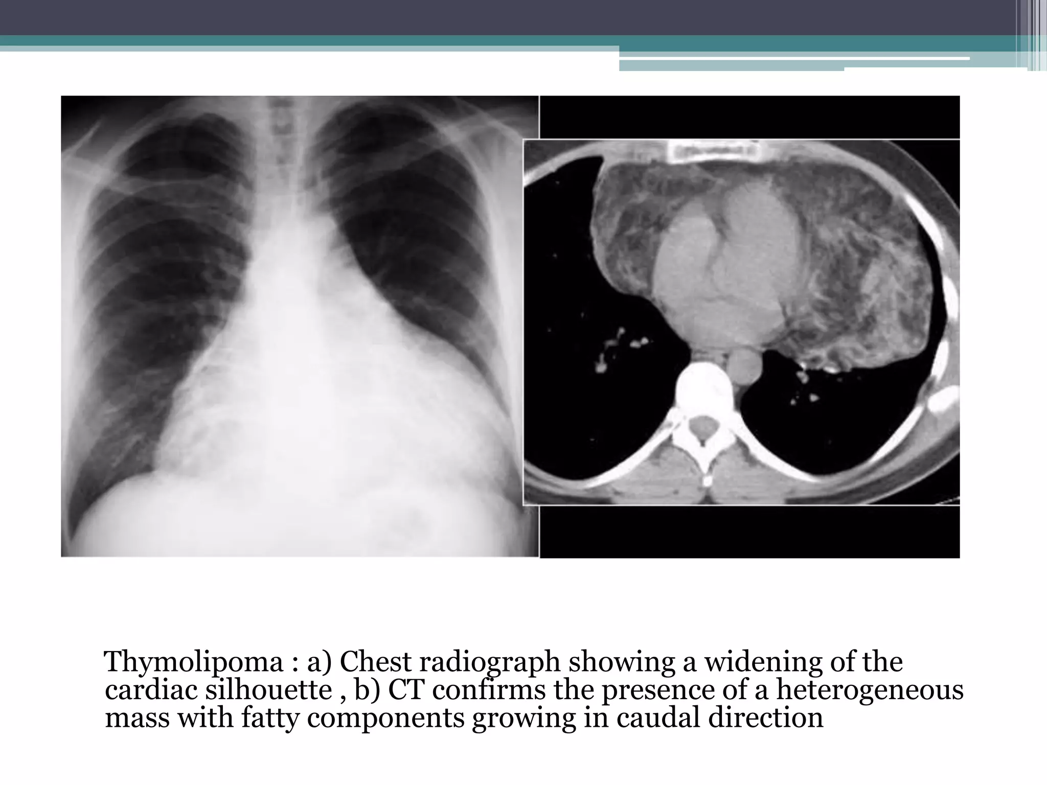 Radiological imaging of mediastinal masses | PPTX