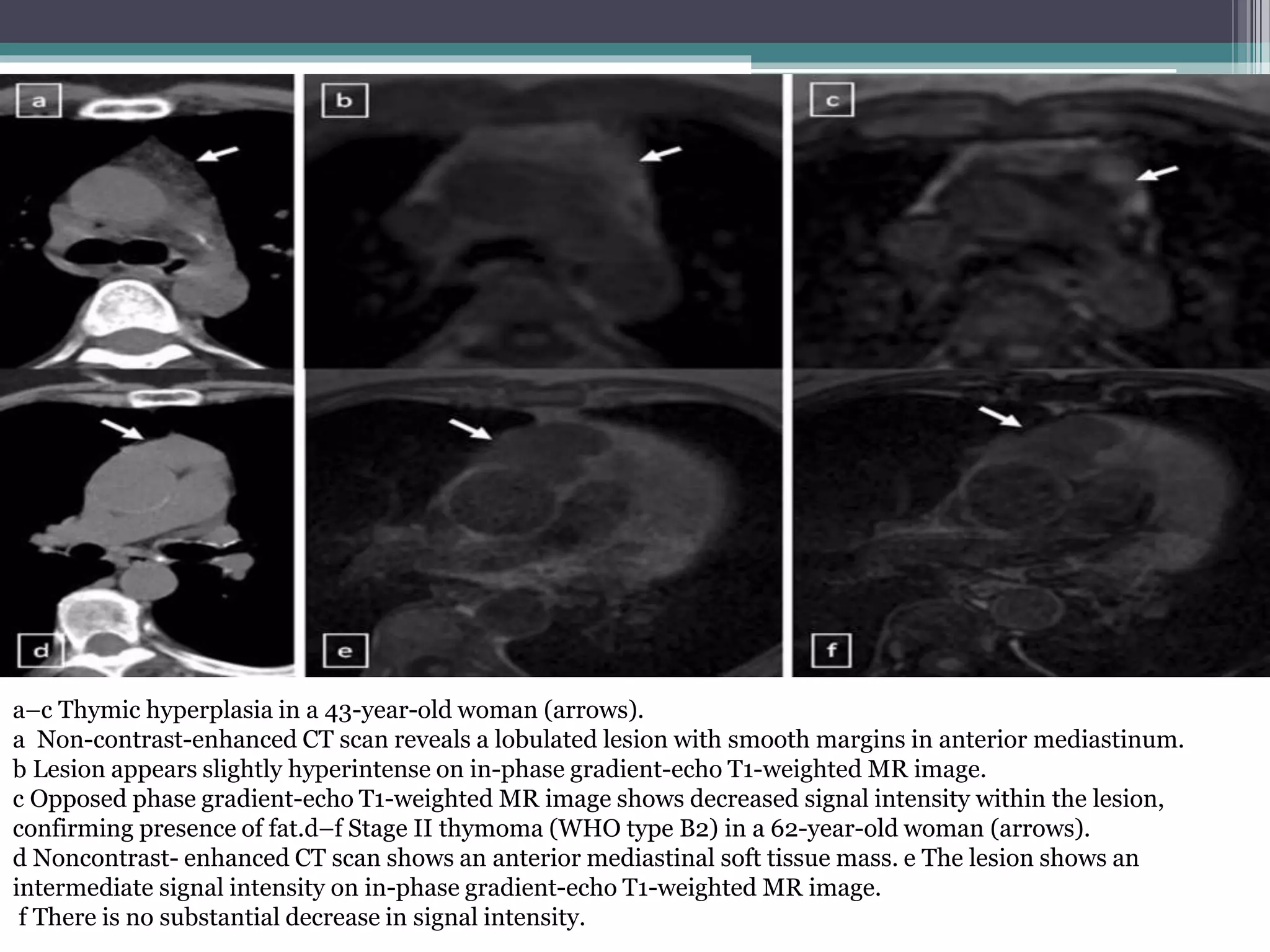 Radiological imaging of mediastinal masses | PPTX