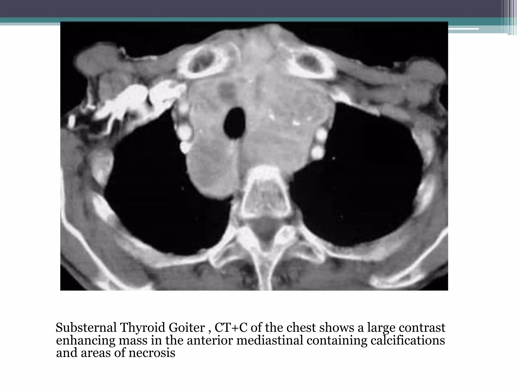 Radiological imaging of mediastinal masses | PPTX