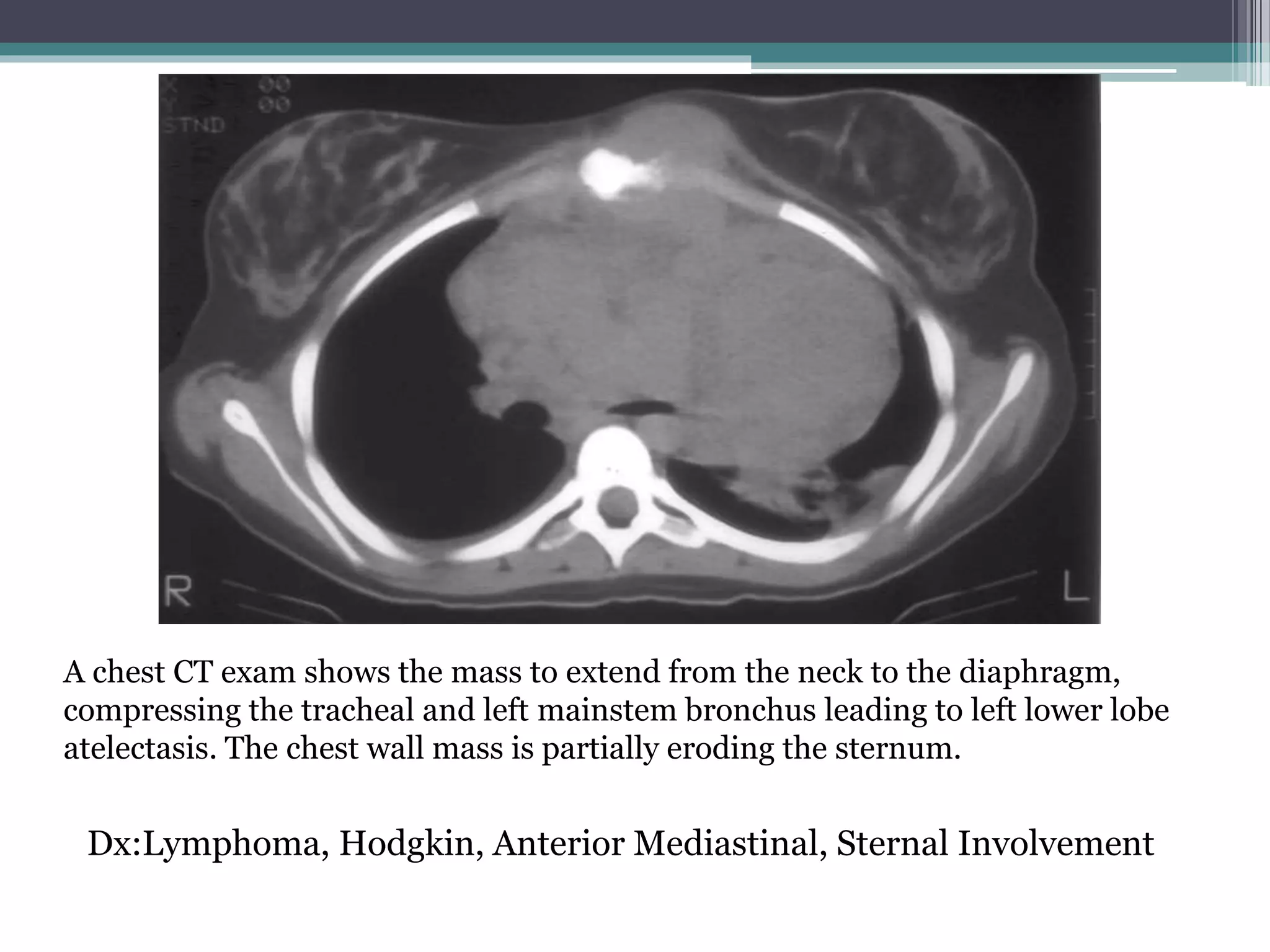 Radiological imaging of mediastinal masses | PPTX