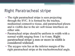 Radiological imaging of mediastinal masses | PPTX
