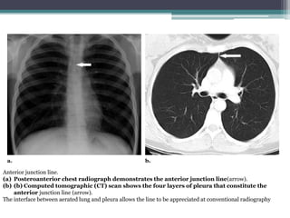 Radiological imaging of mediastinal masses | PPTX