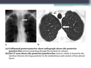 Radiological imaging of mediastinal masses | PPTX