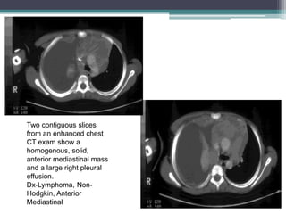 Radiological imaging of mediastinal masses | PPTX