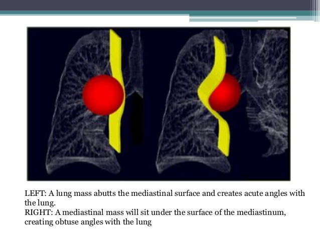 Radiological imaging of mediastinal masses
