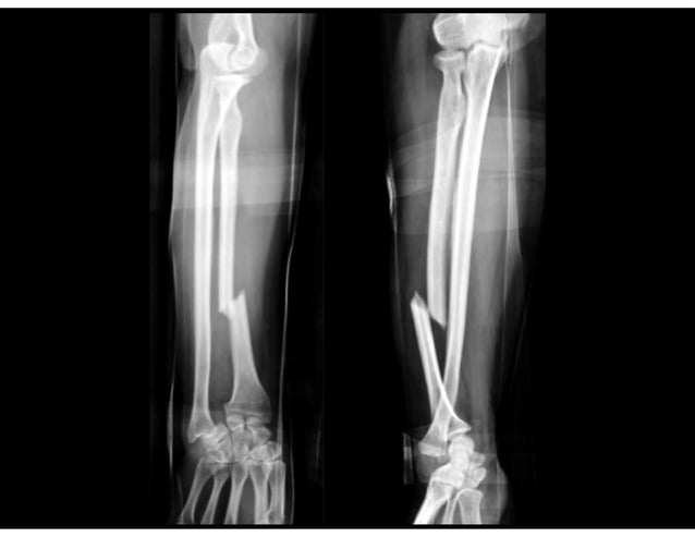 Radiological Imaging of Musculoskeletal Trauma.pdf