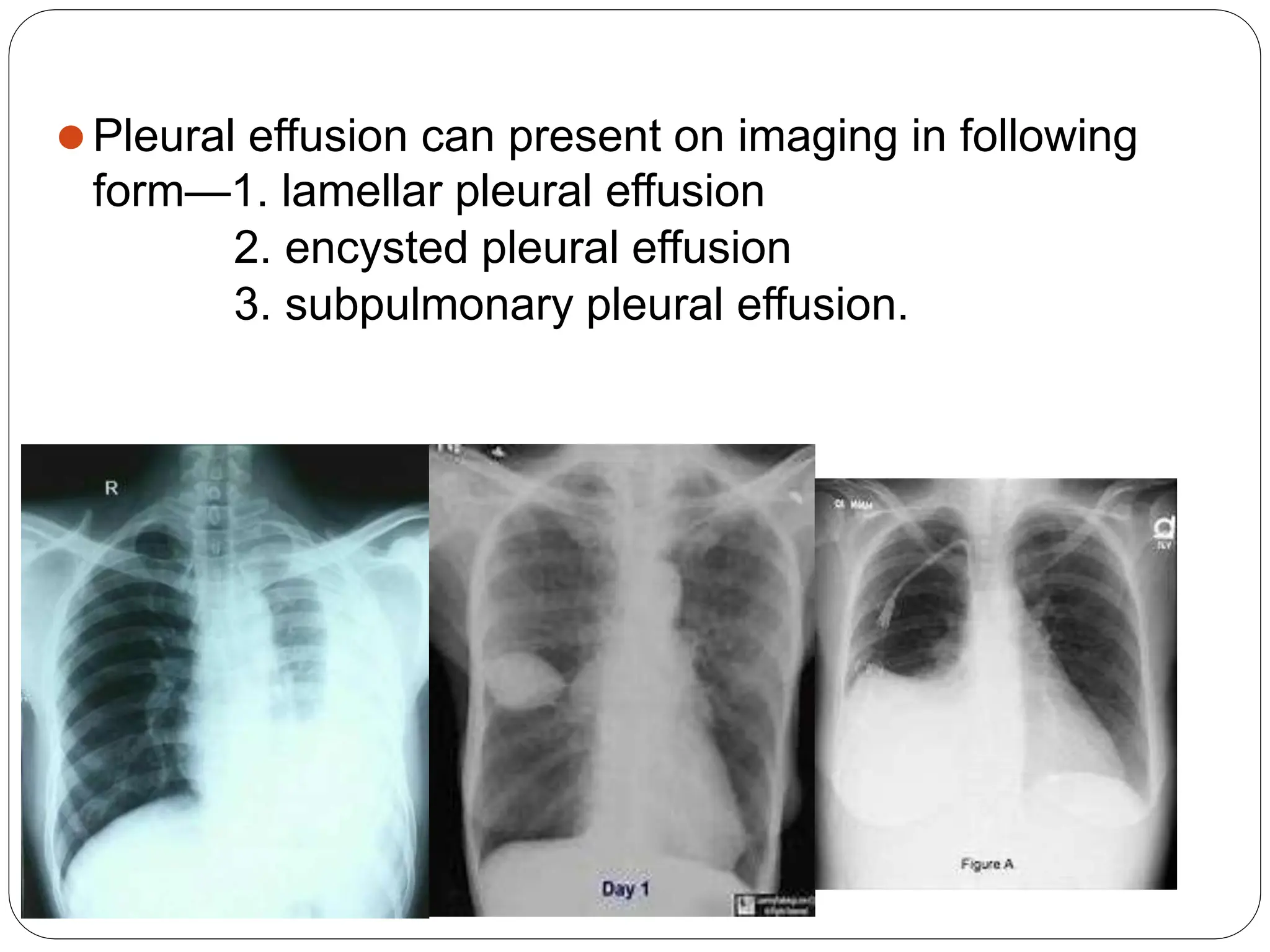 radiologicalimagingofpleuraldiseases2-170304105616.pptx