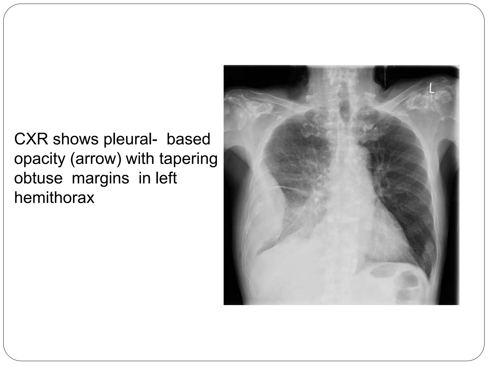 radiologicalimagingofpleuraldiseases2-170304105616.pptx
