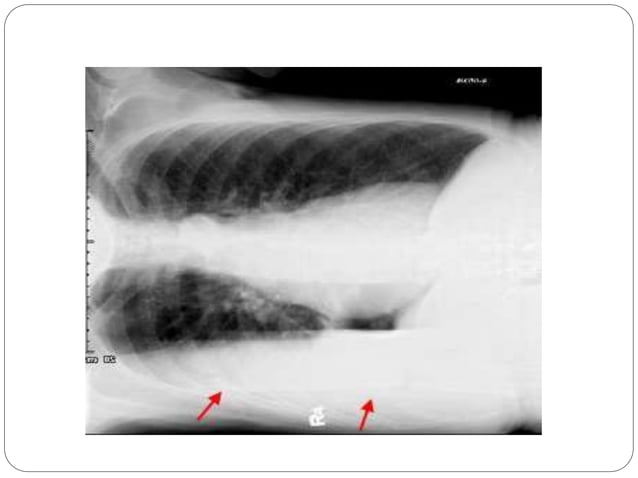 radiologicalimagingofpleuraldiseases2-170304105616.pptx