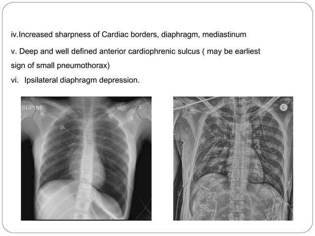 radiologicalimagingofpleuraldiseases2-170304105616.pptx