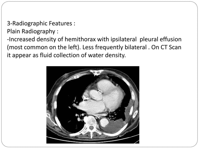 radiologicalimagingofpleuraldiseases2-170304105616.pptx