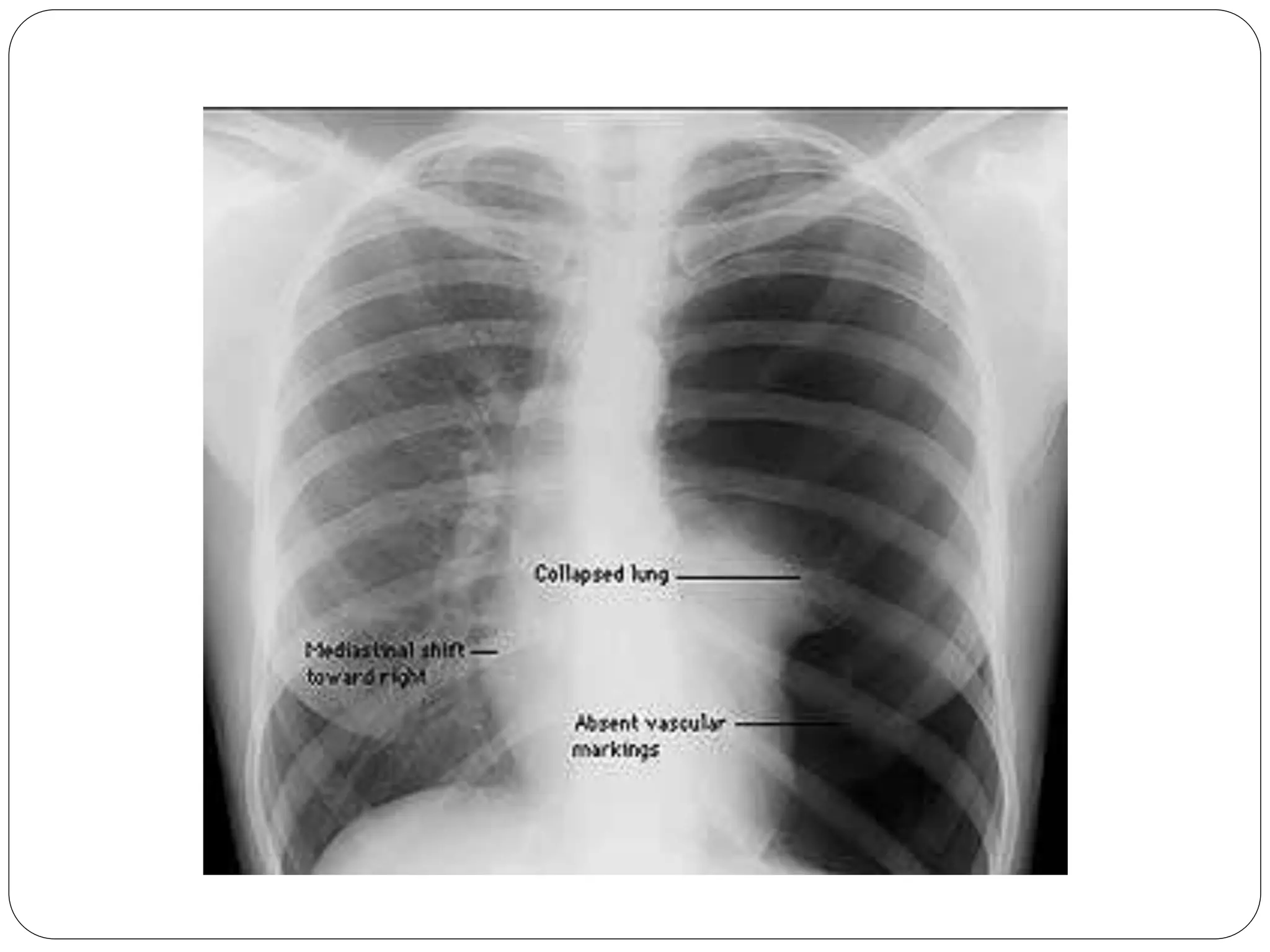 Radiological imaging of pleural diseases | PPTX