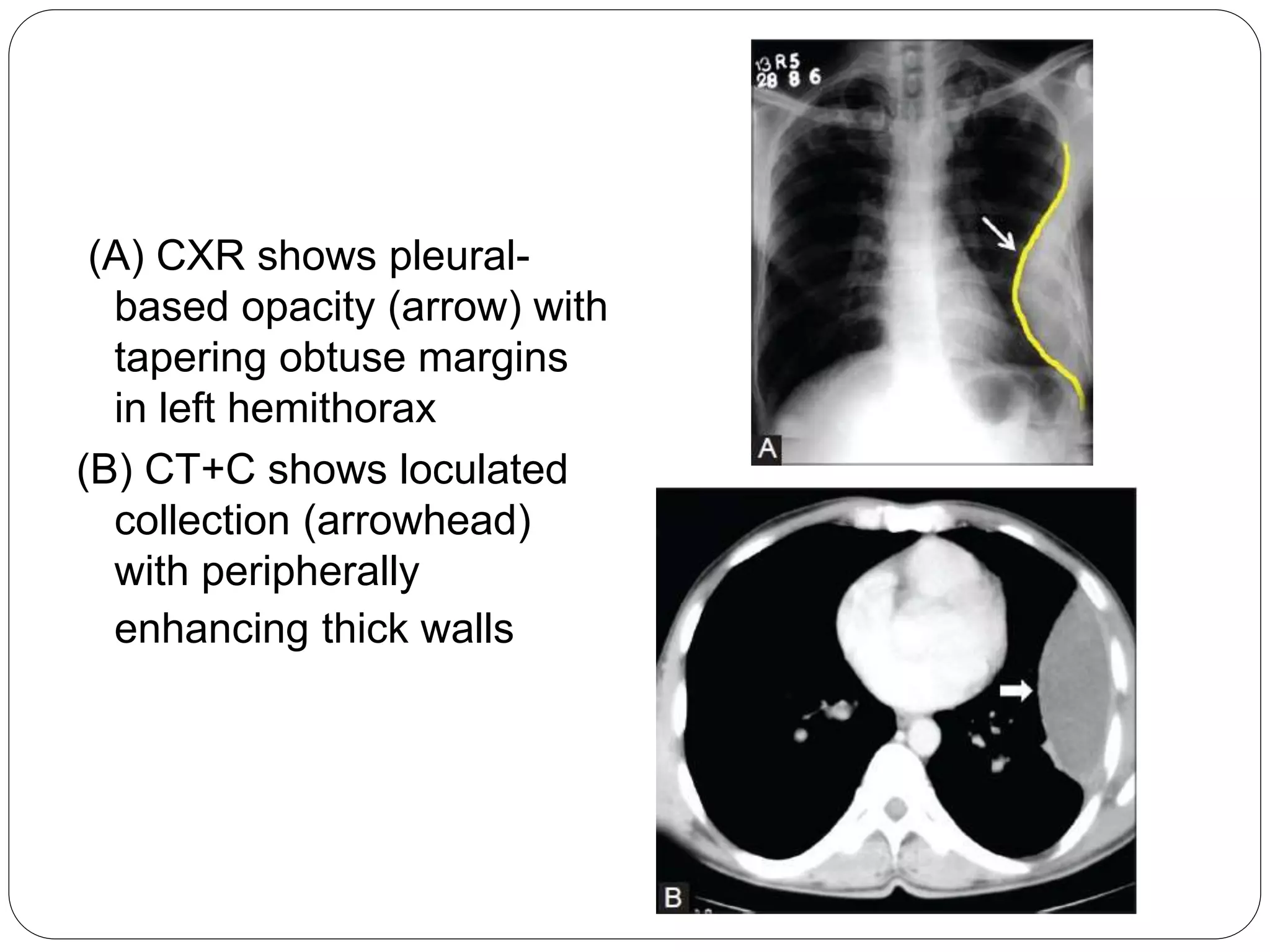 Radiological imaging of pleural diseases | PPTX
