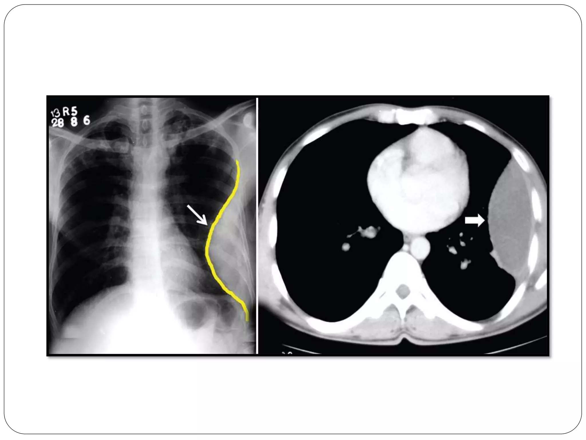 Radiological imaging of pleural diseases | PPTX