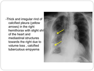 Radiological imaging of pleural diseases | PPTX
