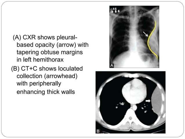 Radiological imaging of pleural diseases | PPTX