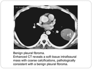 Radiological imaging of pleural diseases | PPTX