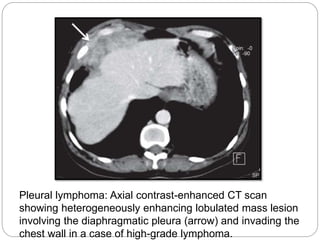 Radiological imaging of pleural diseases | PPTX