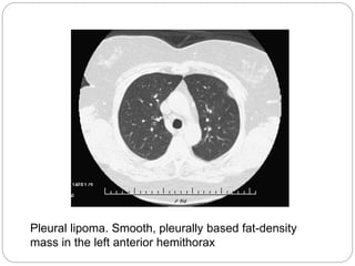 Radiological imaging of pleural diseases | PPTX