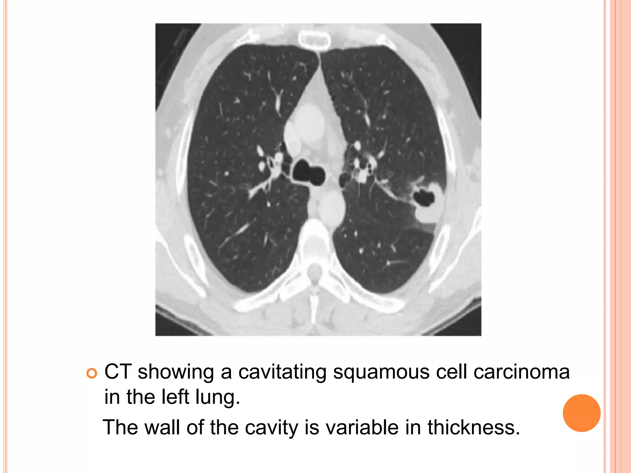 Radiological imaging of pulmonary neoplasms | PPTX