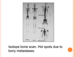Radiological imaging of pulmonary neoplasms | PPTX