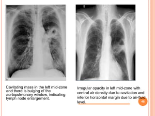 Radiological imaging of pulmonary neoplasms | PPTX
