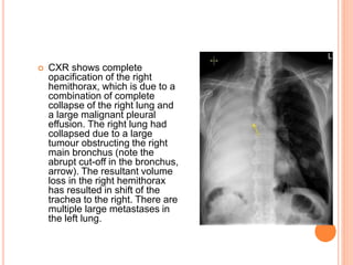 Radiological imaging of pulmonary neoplasms | PPTX
