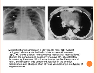 Radiological imaging of pulmonary neoplasms | PPTX