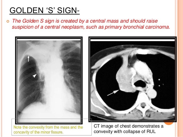 Radiological imaging of pulmonary neoplasms