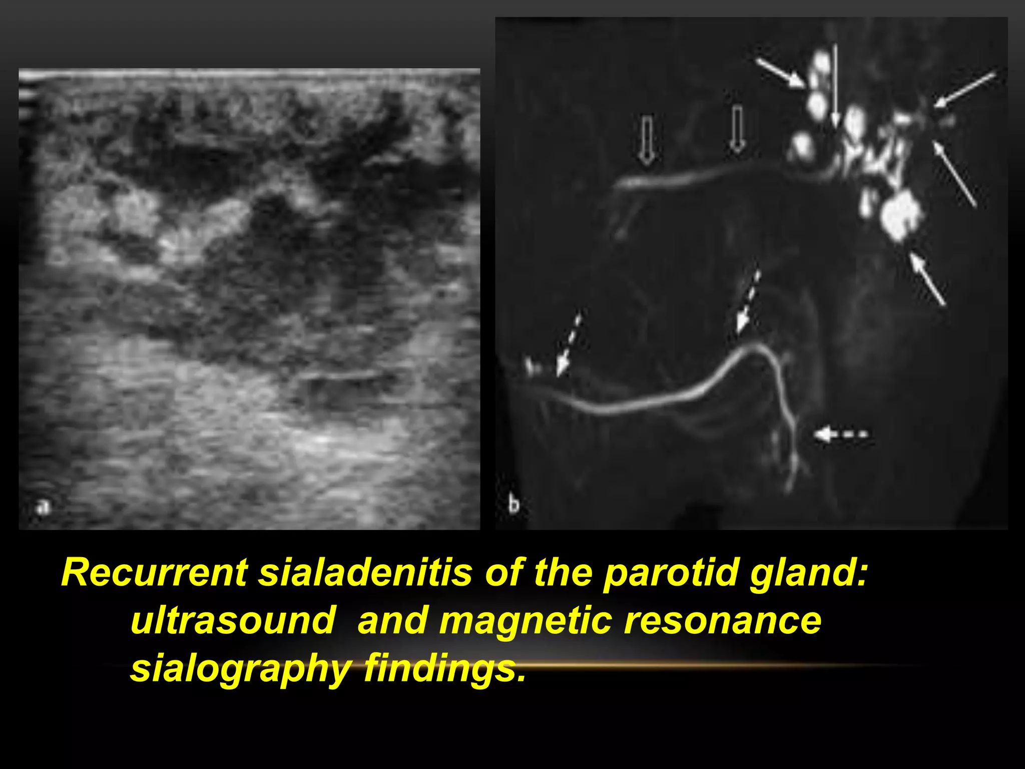 Radiological imaging of salivary gland diseases. | PPTX